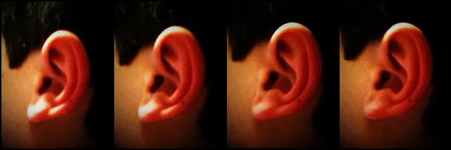 FDA approves cochlear implant designed for MRI | MedTech Dive