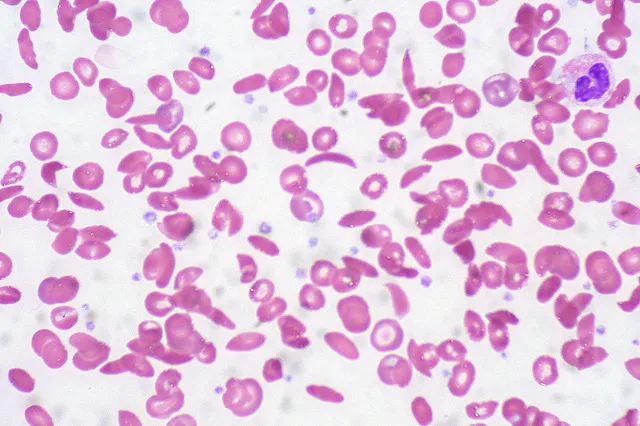 Novartis sickle cell drug wins FDA approval | BioPharma Dive