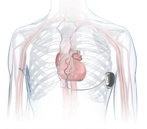 Medtronic gains FDA approval for extravascular defibrillator | MedTech Dive