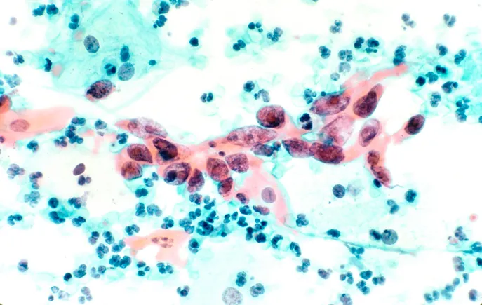 Seagen, Genmab win speedy FDA approval for cervical cancer drug ...