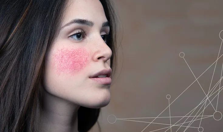 Amplifying lupus disease activity with real-world data and machine ...