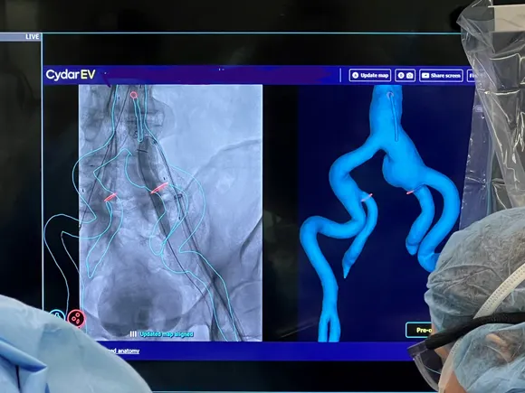 Medtronic’s endovascular artificial intelligence pilot program treats ...