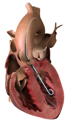 Abiomed wraps up Impella post-approval studies requested by FDA | MedTech Dive