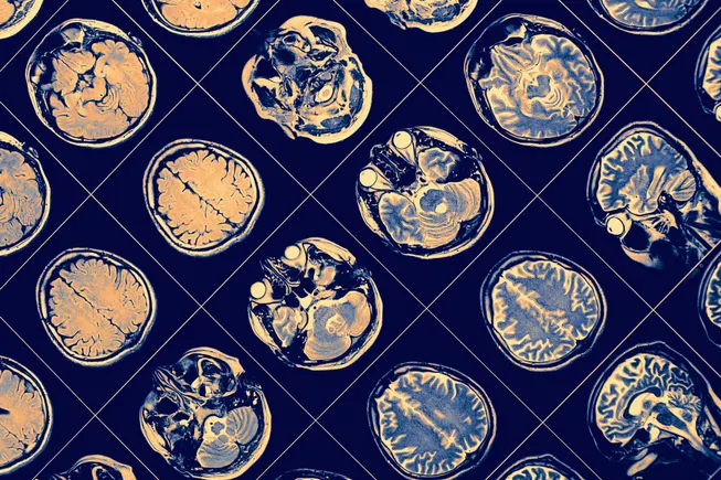 Brii Biosciences aims to come up big where Sage and Biogen fell short ...